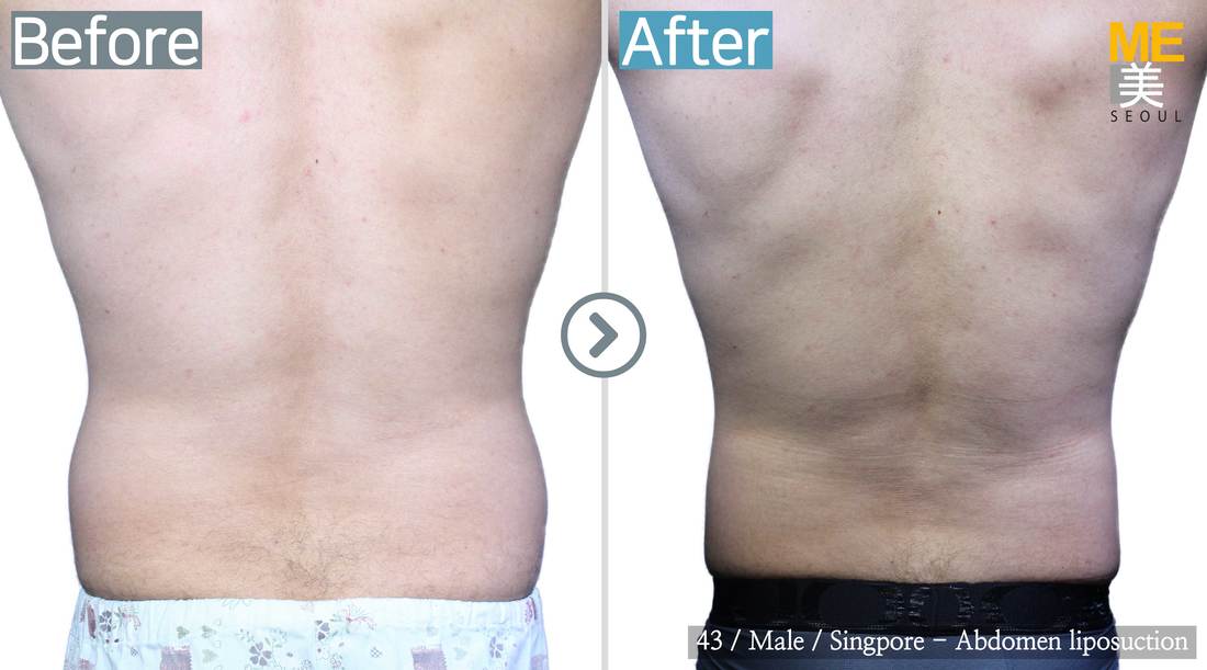 Liposuction - ME CLINIC SEOUL