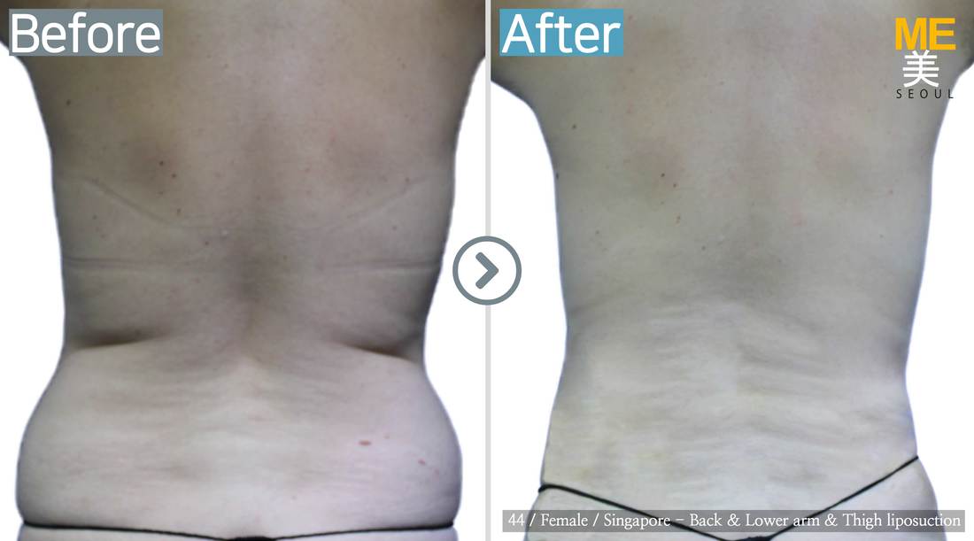 Liposuction - ME CLINIC SEOUL