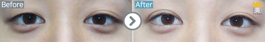 Double eyelids - ME CLINIC SEOUL