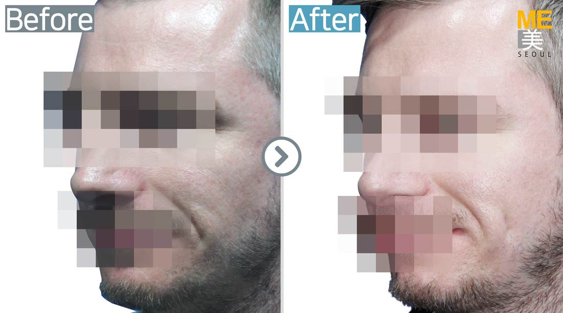 Dimple surgery - ME CLINIC SEOUL