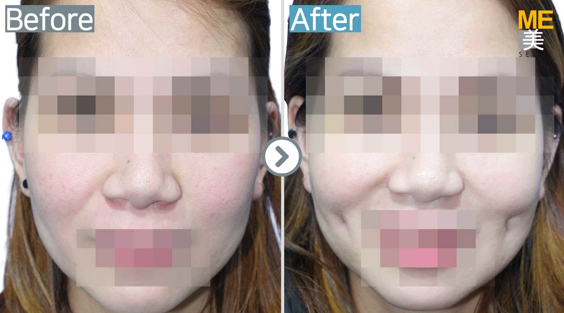 Dimple surgery - ME CLINIC SEOUL